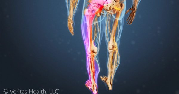 Back Pain & Sciatica