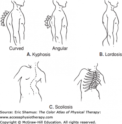 Kyphosis, round shoulders and dowagers hump