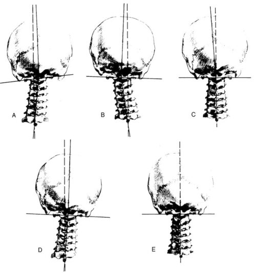 The hidden secret behind scoliosis Part 1