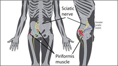 Sciatica & piriformis syndrome - A constant confusion & do they exist?