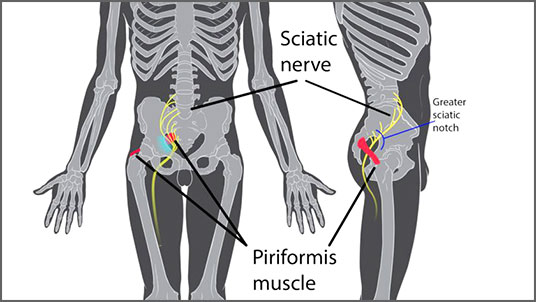 Sciatica & piriformis syndrome - A constant confusion & do they exist?