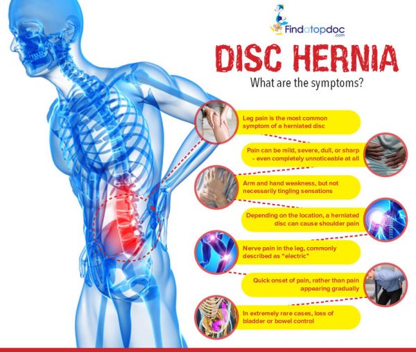 Prolapsed, herniated disc